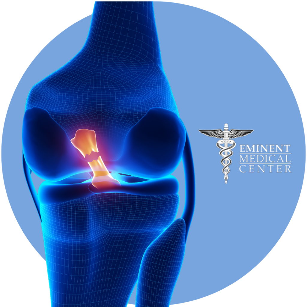 ACL Tear Treatment in Richardson, TX | Eminent Medical Center