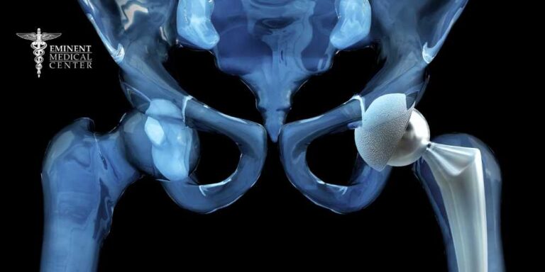 Partial Hip Replacement in Richardson and Dallas, TX