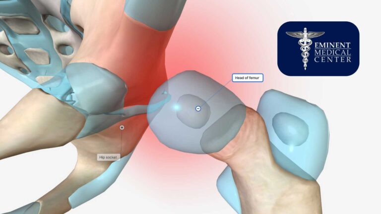 Dallas and Richardson Hip Surgery | Eminent Medical Center