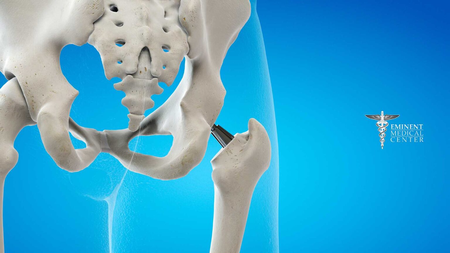 Hip Resurfacing Surgery Center Richardson and Dallas, Texas