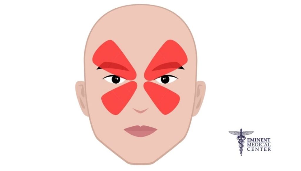 Head Pain Diagram | Types of Headaches and Headache Locations