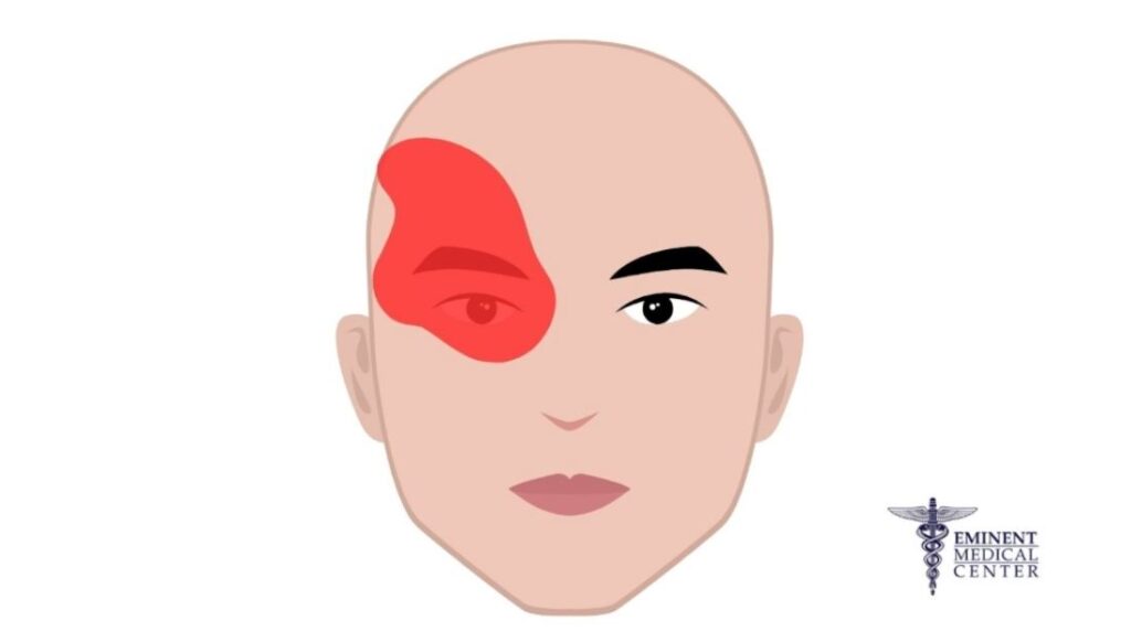 Head Pain Diagram | Types of Headaches and Headache Locations