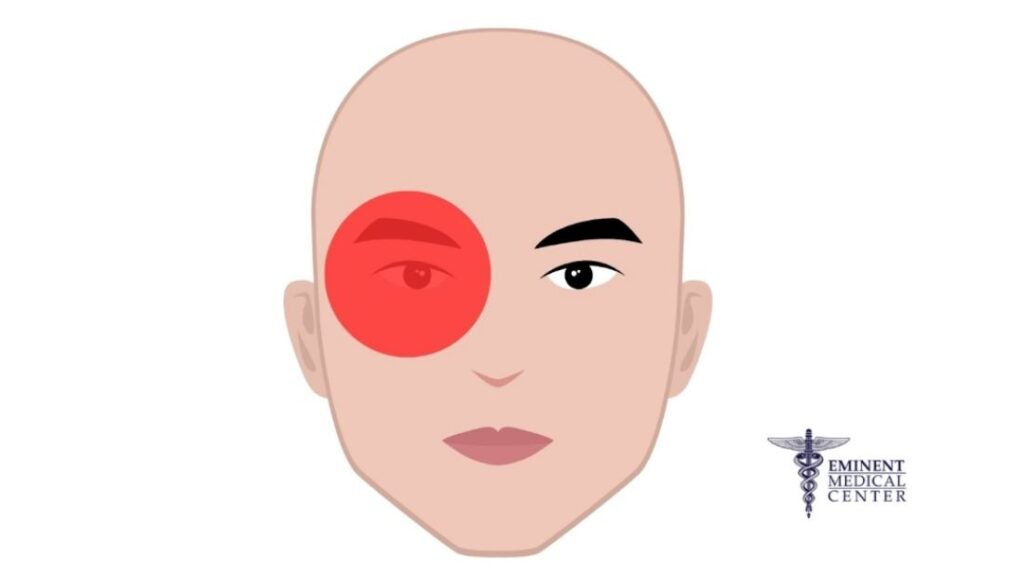 Head Pain Diagram | Types of Headaches and Headache Locations