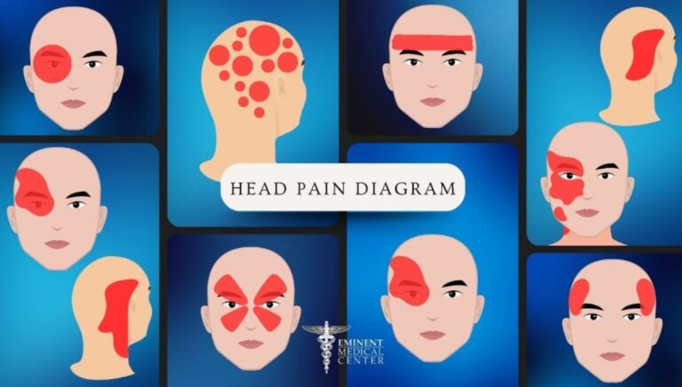 Head Pain Diagram | Types of Headaches and Headache Locations