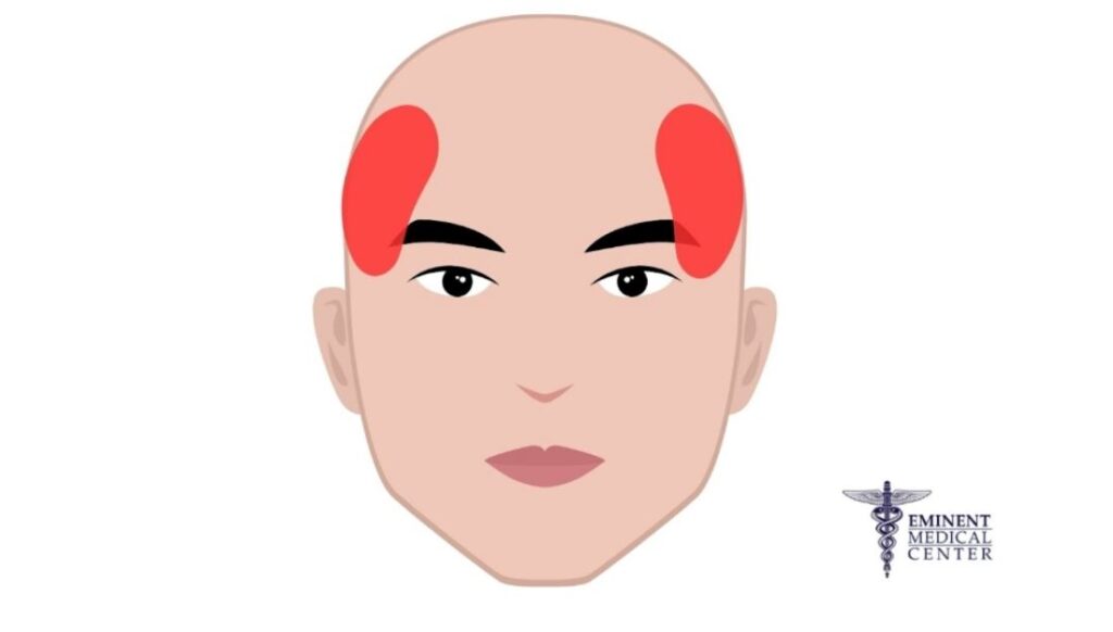 Head Pain Diagram | Types of Headaches and Headache Locations