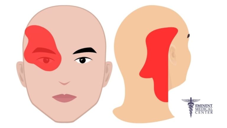 Head Pain Diagram | Types of Headaches and Headache Locations