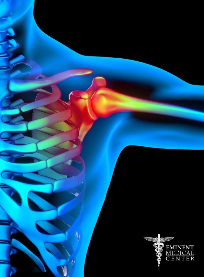 Shoulder Arthroscopy Dallas and Richardson, Texas | Eminent